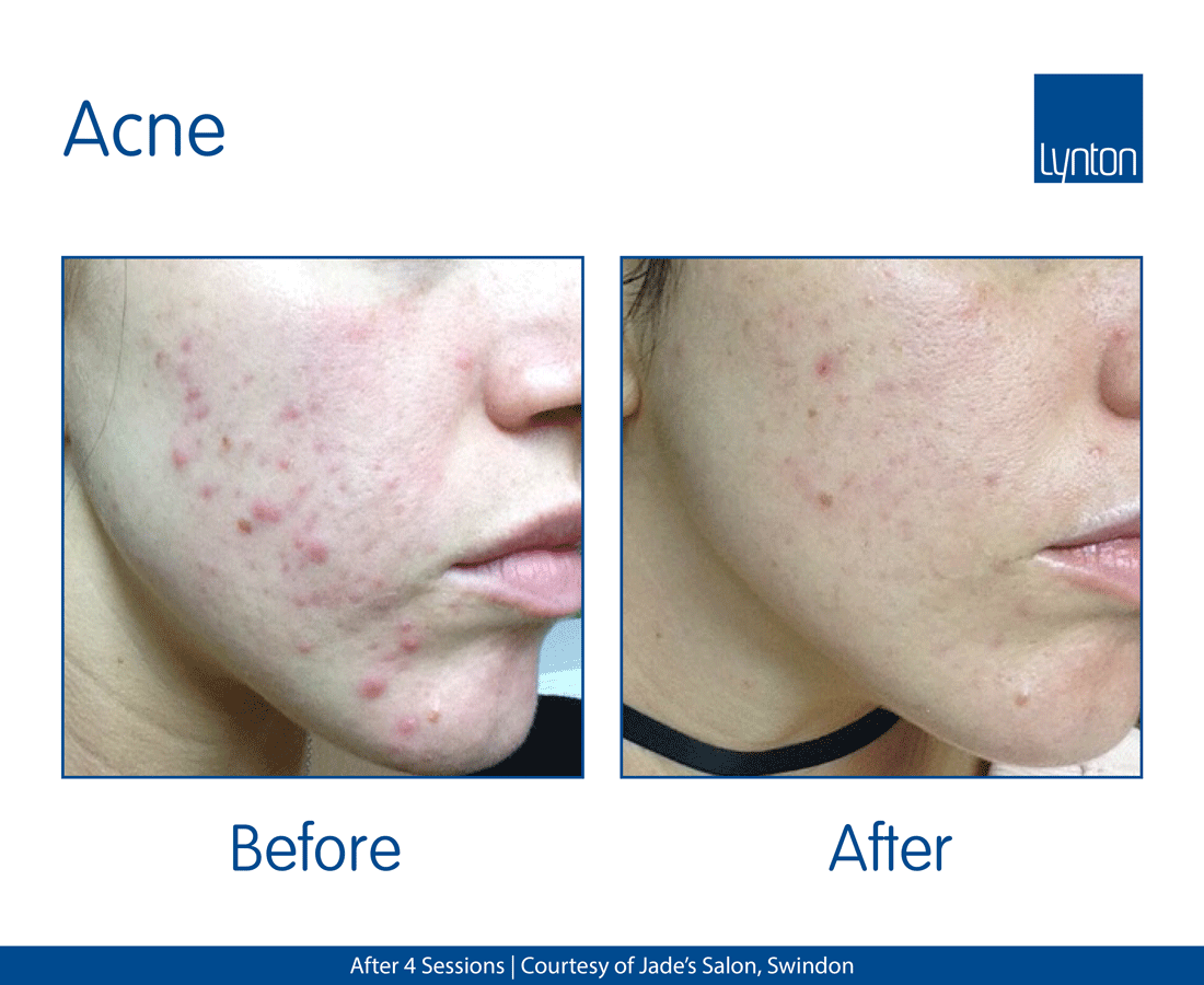 Acne IPL Treatment - Expert Acne Care with IPL Therapy