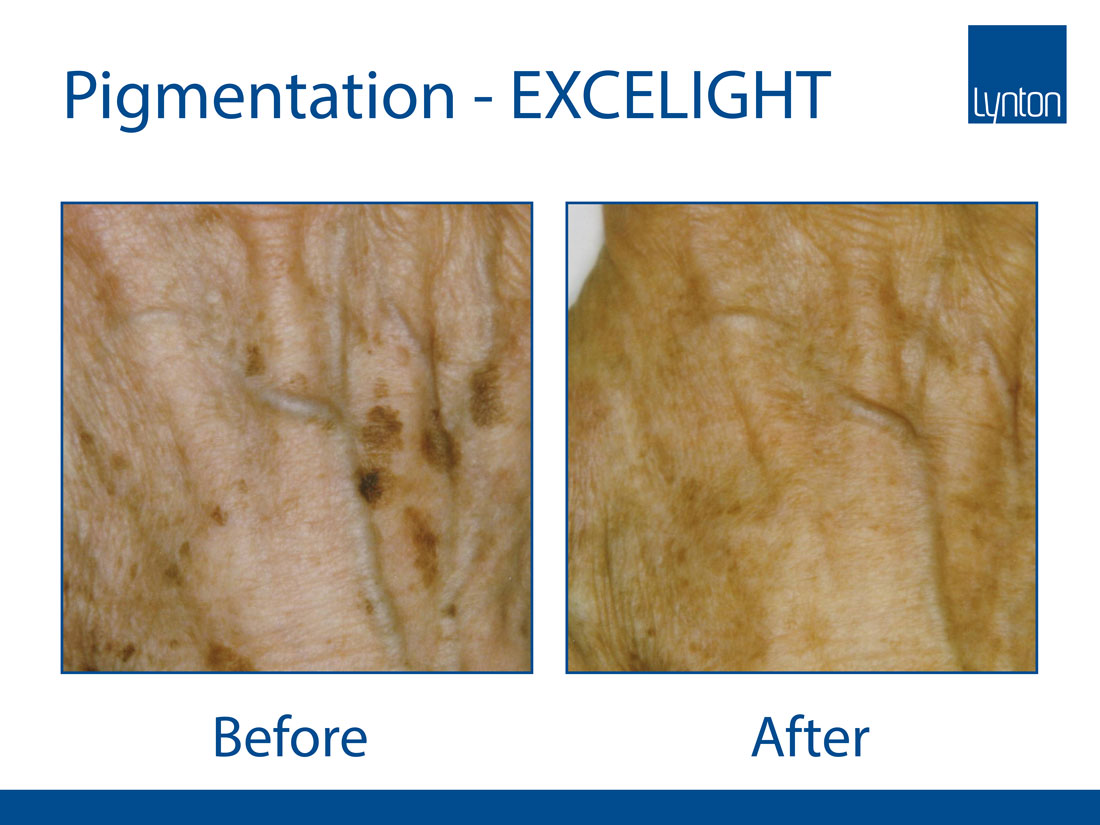 IPL Pigmentation Treatment - Laser for Skin Pigmentation