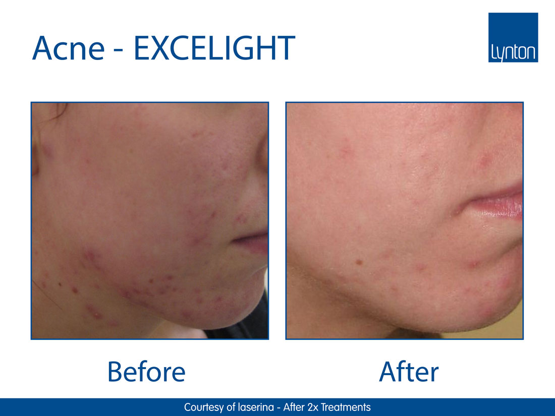 Acne IPL Treatment - Expert Acne Care with IPL Therapy