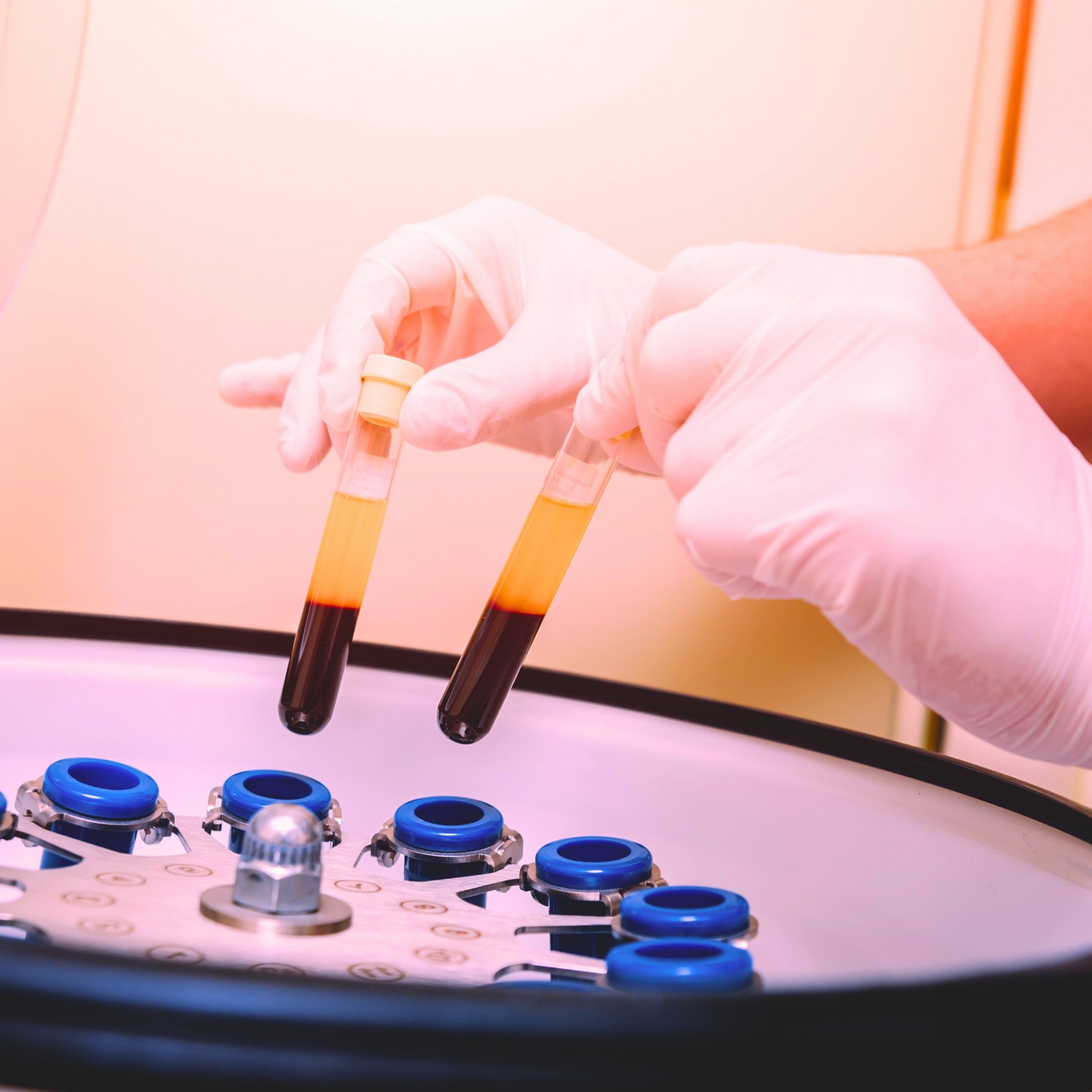 PRP Therapy for Skin and Hair: Benefits, Process and Safety